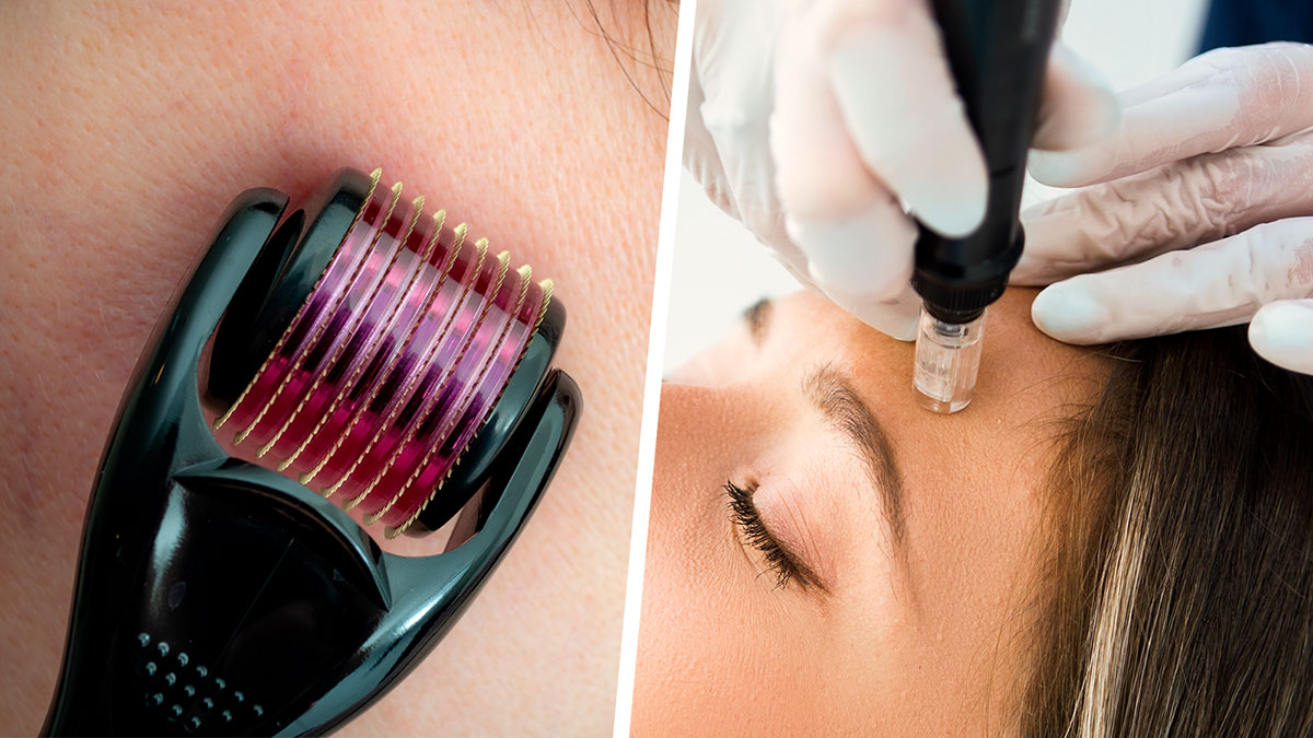 Microneedling With PRP: Before and After Results + Photos ...